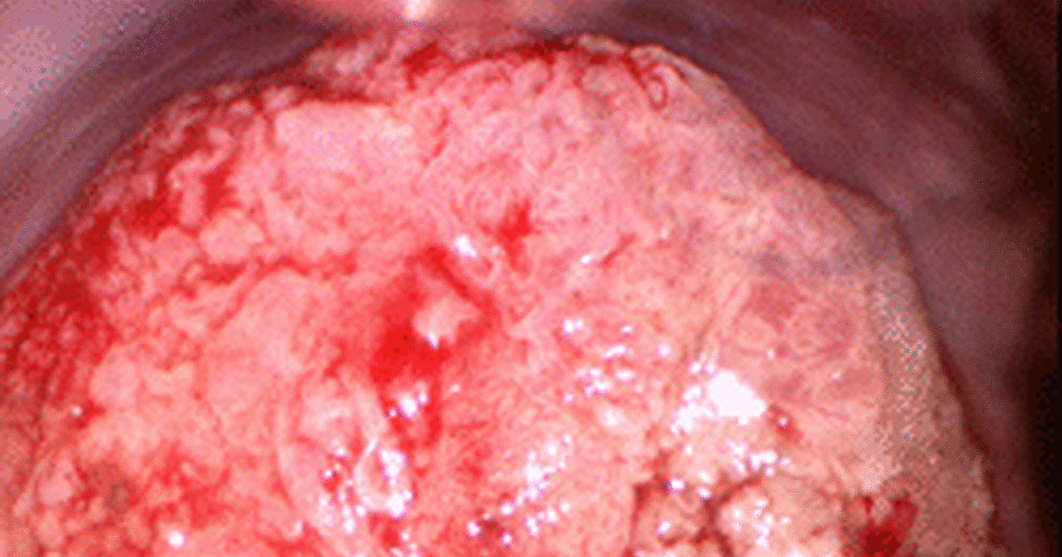 cervical polyps nhs uk