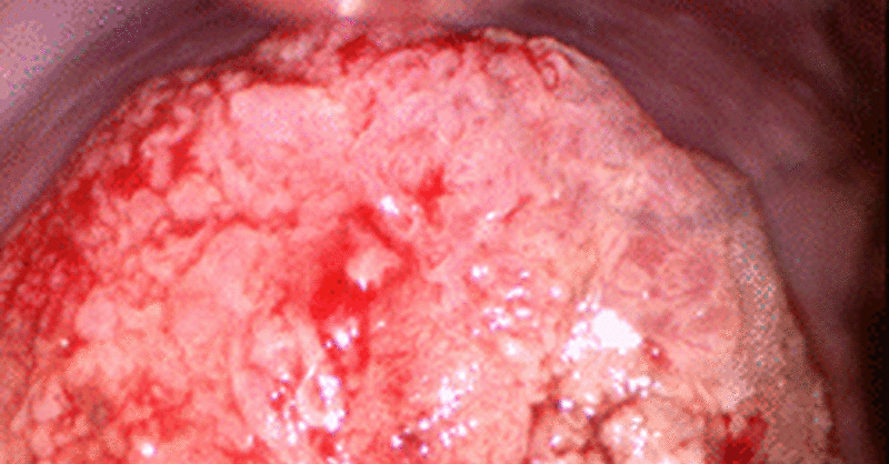 cervical cancer colposcopy images